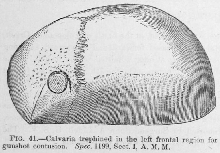 behind AotW » Blog Archive » Calvaria trephined in the left frontal ...